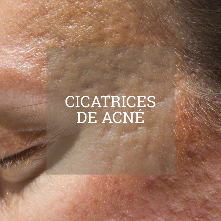 Tratamientos Faciales - Epidermos Instituto de dermoestética